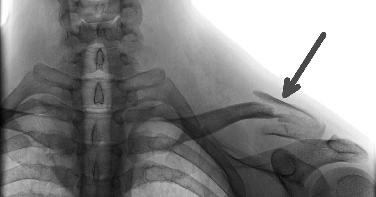 What We Know About Onewheel Injuries So Far | Bailey Cowan Heckaman PLLC